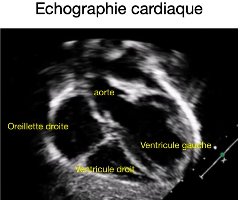 Souffle au coeur | Cardiologie-Intercard