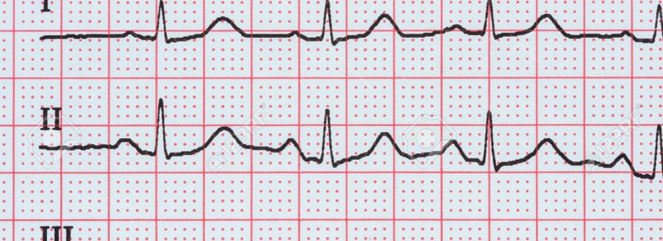 Électro cardiogramme (ECG) | Cardiologie-Intercard